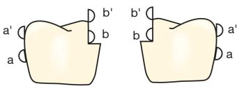 Guide planes – A Guide to Removable Partial Denture Planning