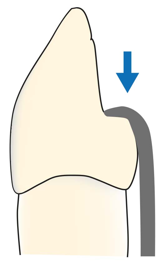 Cingulum rest – A Guide to Removable Partial Denture Planning