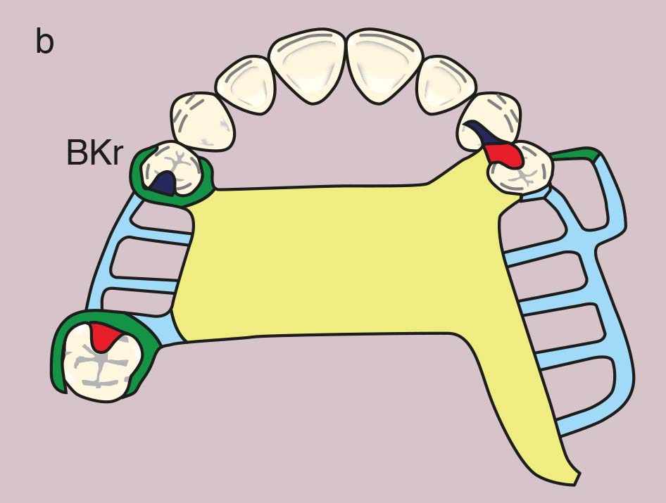 Kennedy Cl II – Hareketli Bölümlü Protezlerlerde Planlama